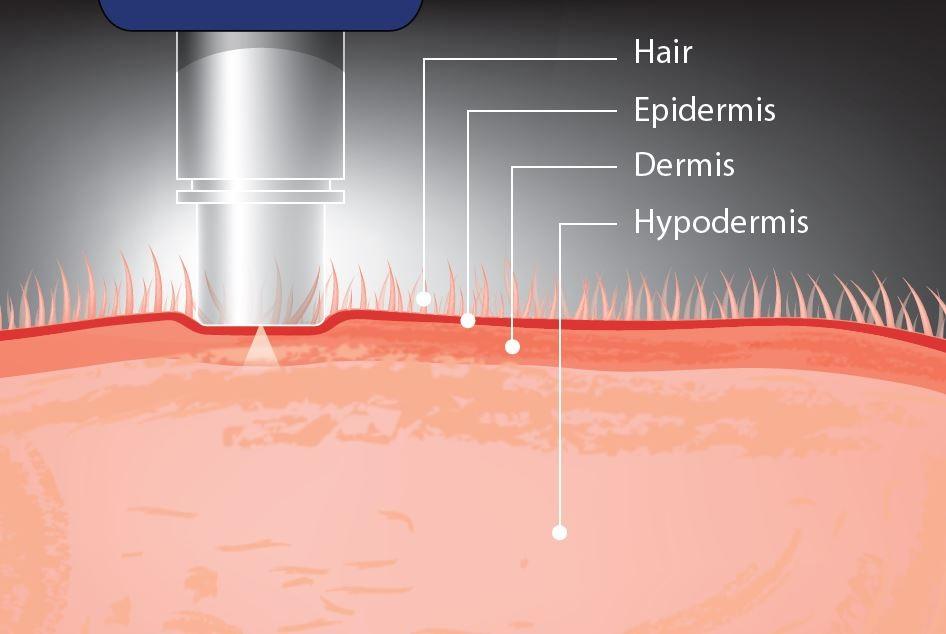 IDAL Intradermal Needleless Vaccination